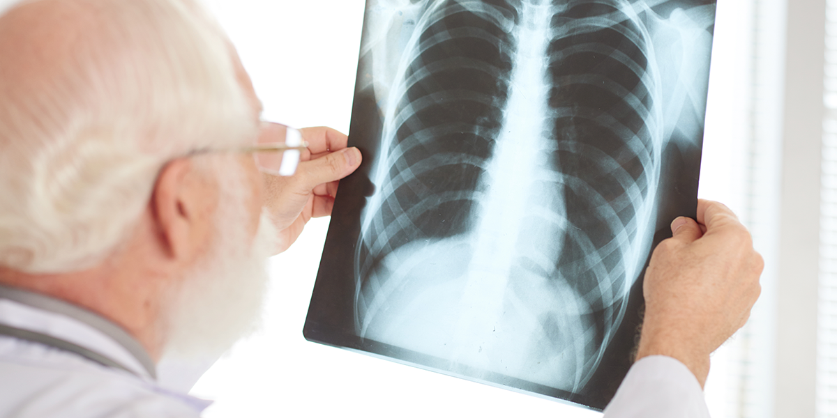 Tuberculose: sintomas, diagnóstico e tratamento - Clínica CEU Diagnósticos