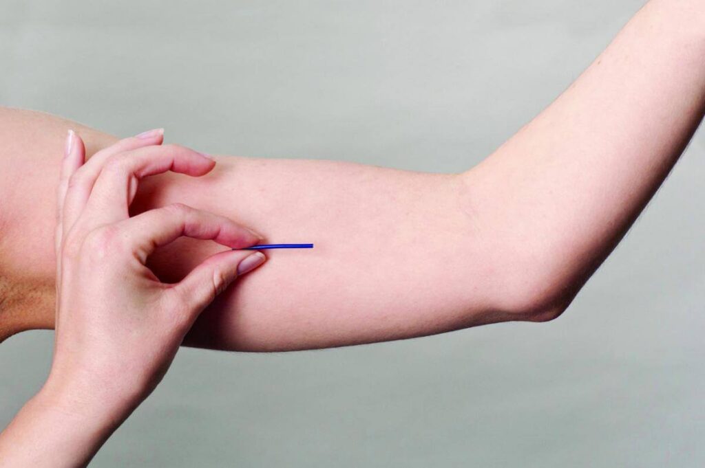 Implanon: o que é, como funciona e vantagens do implante